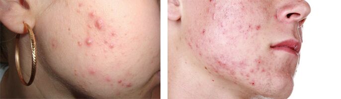 Parasites sous-cutanés chez l'homme: symptômes, traitement avec des ...